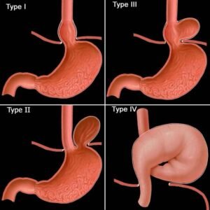 Hiatal Hernia Types Explained: Sliding, Rolling, and Mixed - Tummy Cure