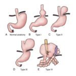 Hiatal Hernia Types Explained: Sliding, Rolling, and Mixed - Tummy Cure